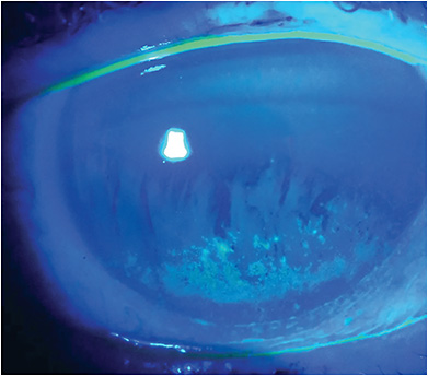 Following the 3 Latest Dry Eye Disease Algorithms | Corneal Physician