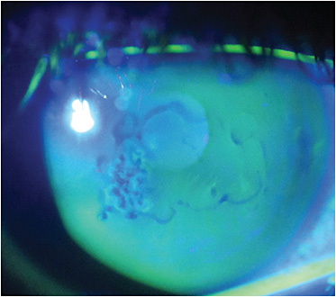 Corneal Physician | PentaVision