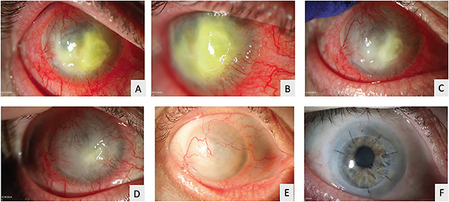 Cross-linking for Infectious Keratitis | Corneal Physician