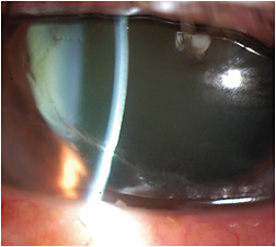 Corneal Physician | PentaVision