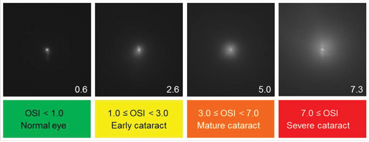 Applying the Objective Scatter Index | Corneal Physician