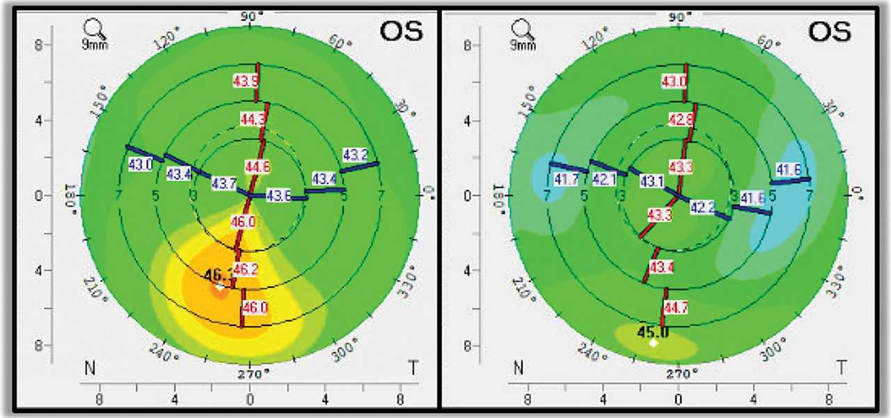 Refractive Options When Faced with Corneal Limitation | Corneal Physician