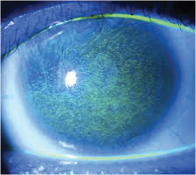 Corneal Physician | PentaVision