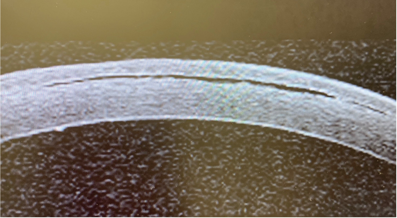 MY CORNEAL SAVE: How I Managed a Rare Post-LASIK Occurence | Corneal ...