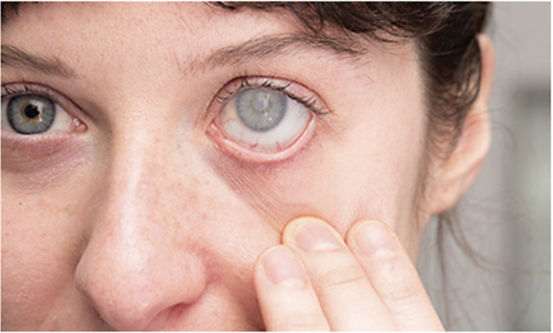 Overcoming Corneal Opacity | Corneal Physician