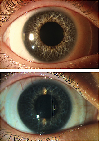 Considering Contact Lens Wear to Prevent Surgery | Corneal Physician