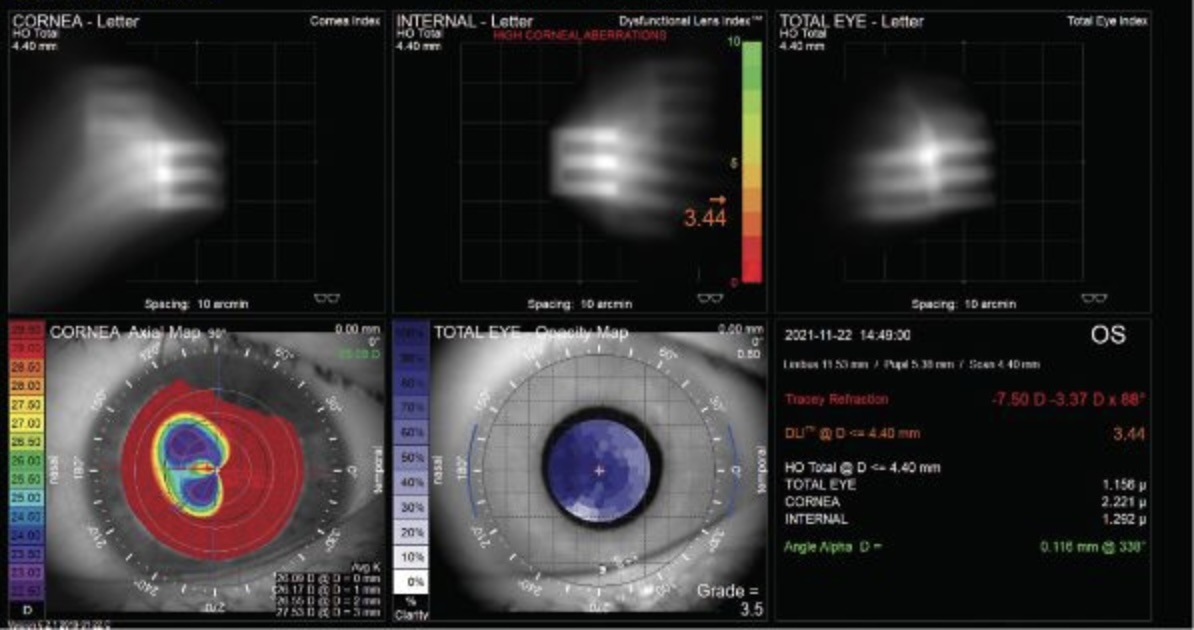 Selecting an IOL | Corneal Physician